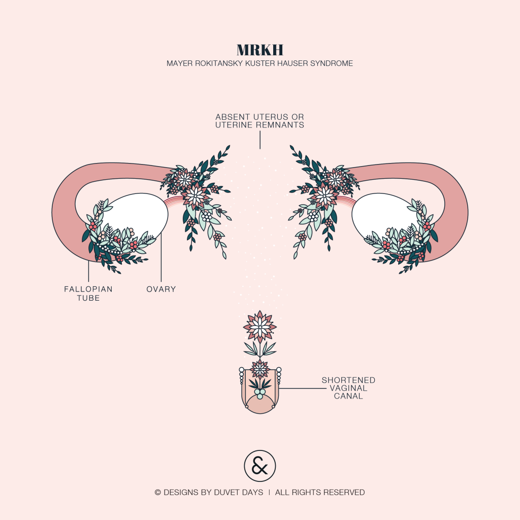 What is MRKH? – MRKH Connect