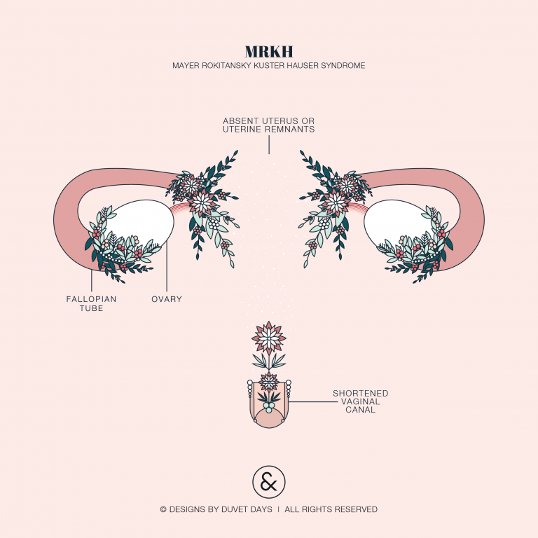 What is MRKH? – MRKH Connect